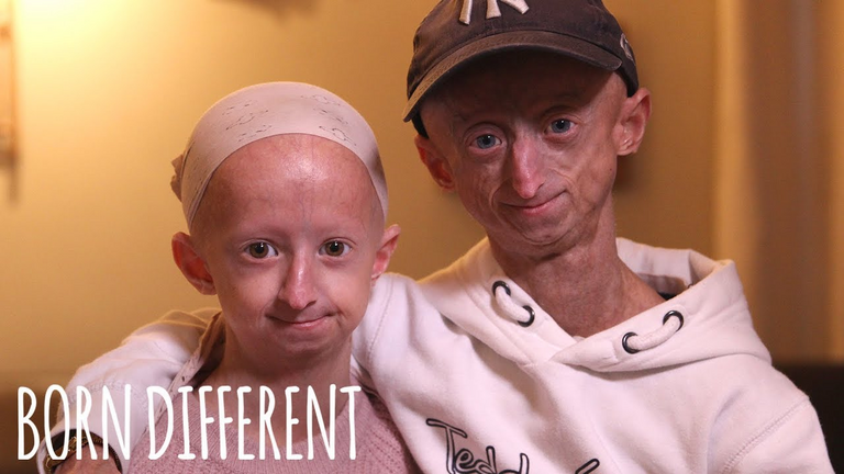 Understanding Progeria (Hutchinson-Gilford Syndrome): Causes, Symptoms ...