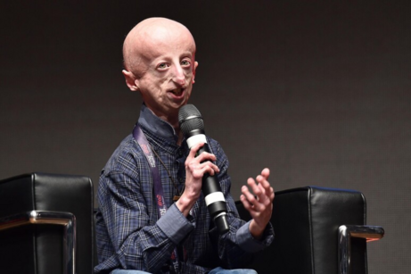 Understanding Progeria (Hutchinson-Gilford Syndrome): Causes, Symptoms ...